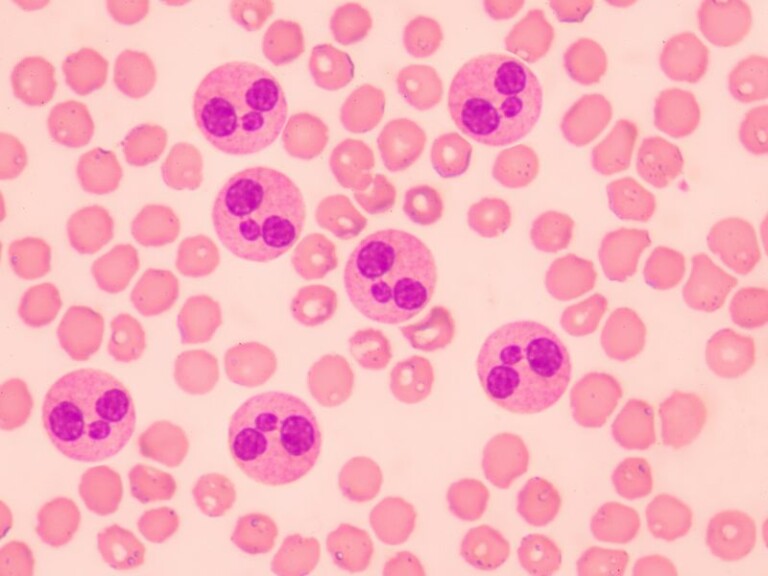 How Cutting Edge Medical Devices Can Detect Sepsis Earlier Pixcell